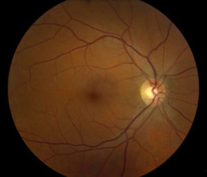 Retinal Disease Management - Georgia Eye Institute