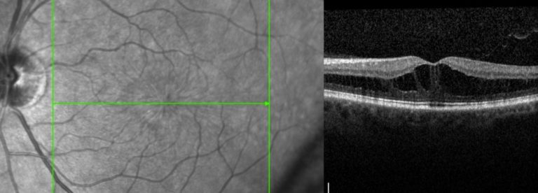 Retinal Disease Management - Georgia Eye Institute